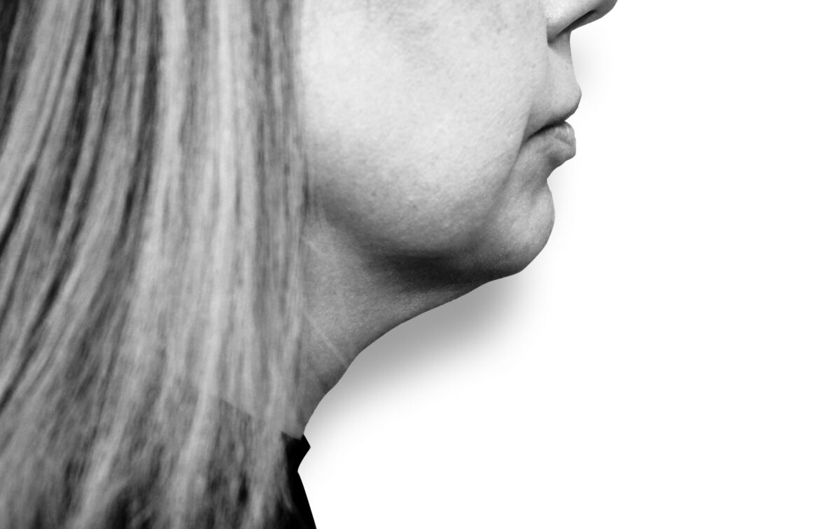 Double-chin? This non-surgical treatment will surprise you! - RVC Medical